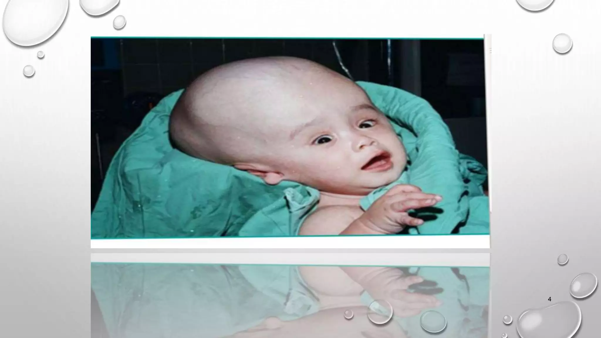 Hydrocephalus & Neural Tube Defecs | PPTX