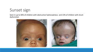 Hydrocephalus (1) (2) | PPTX