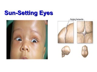 Hydrocephalus | PPT