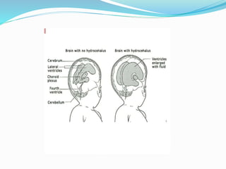HYDROCEPHALUS | PPTX