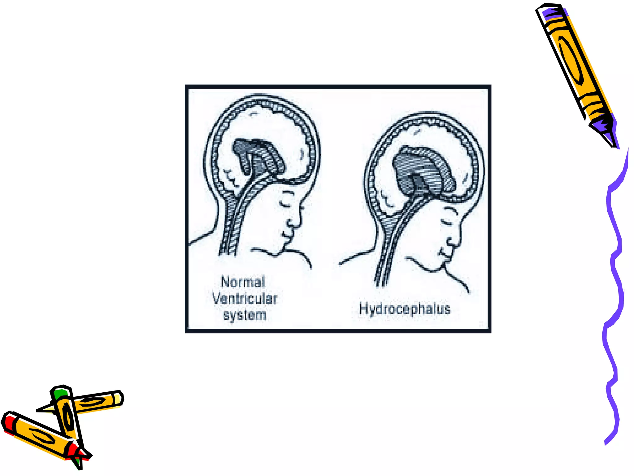HYDROCEPHALUS (2)222.ppt