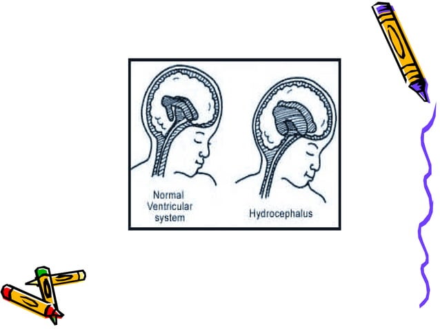 HYDROCEPHALUS (2)222.ppt