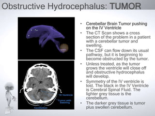 Hydrocephalus and it's causes | PPT