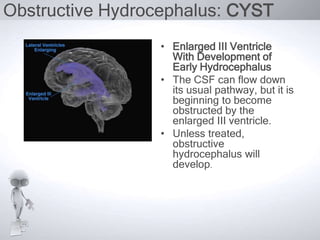 Hydrocephalus and it's causes | PPT