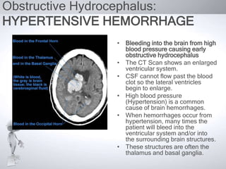 Hydrocephalus and it's causes | PPT