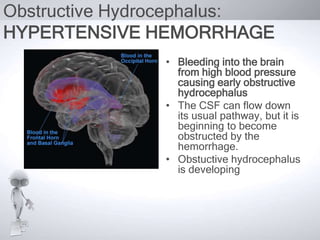 Hydrocephalus and it's causes | PPT