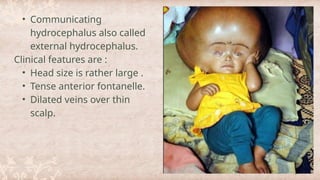 Hydrocephalus and lesions by V.K.sravani | PPTX