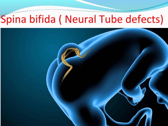 HYDROCEPHALUS & SPINA BIFIDA