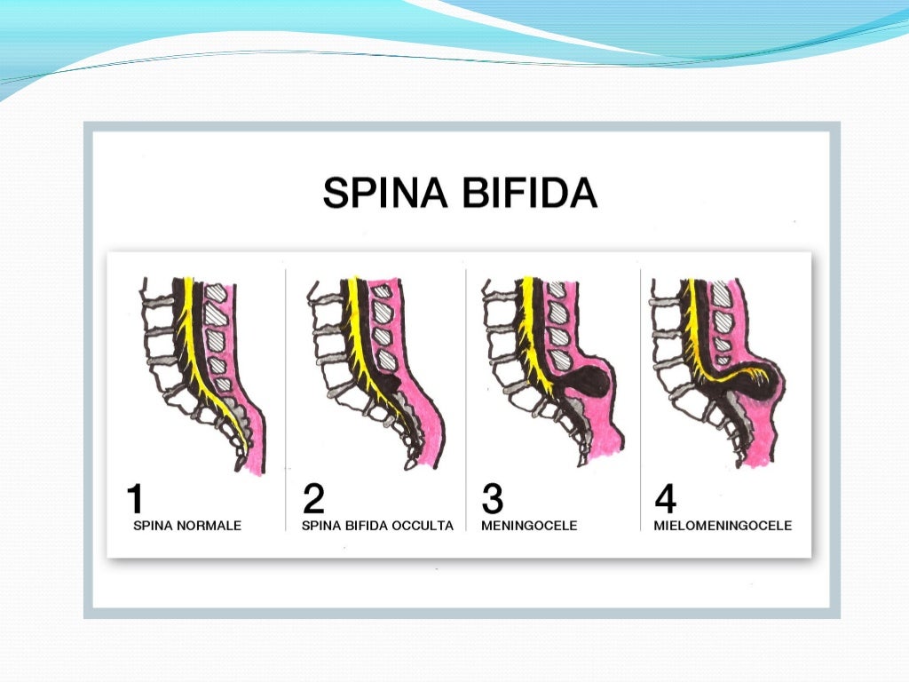 HYDROCEPHALUS & SPINA BIFIDA