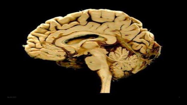 Hydrocephalus | PPTX | Brain and Nervous System Disorders | Diseases ...