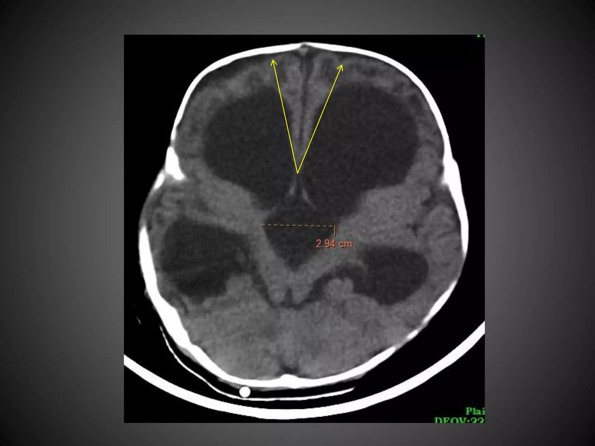 HYDROCEPHALUS case presentation BY DR ABHIJIT R SINGH | PPTX