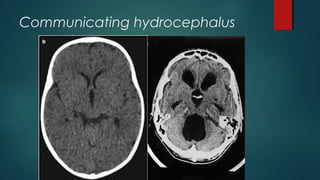 Hydrocephalus | PPT