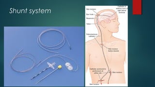Hydrocephalus | PPT
