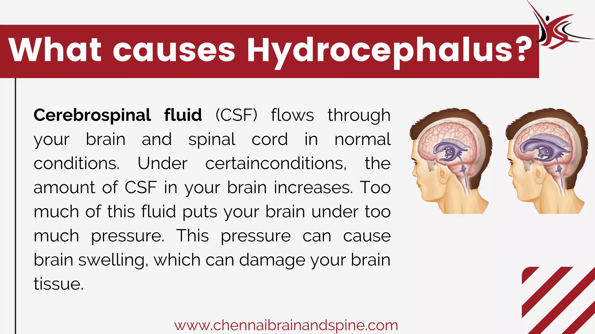Hydrocephalus in adults and children | PDF