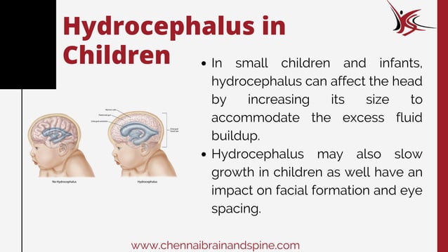 Hydrocephalus in adults and children | PDF | Brain and Nervous System ...
