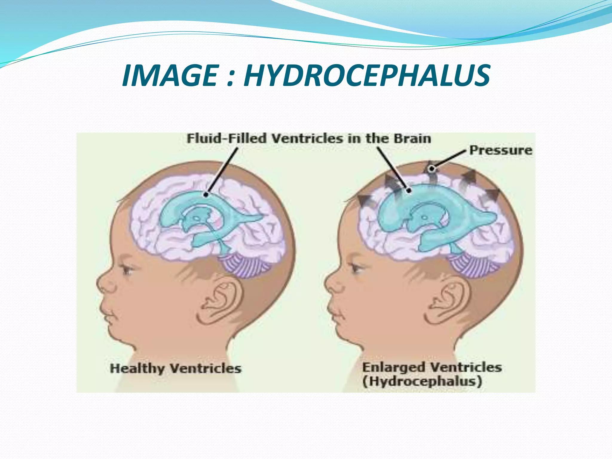 Hydrocephalus : Its Avaliable Treatments | PPT