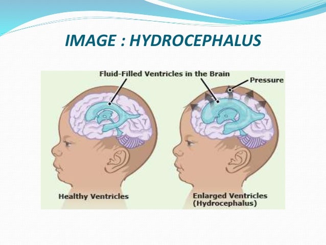 Hydrocephalus : Its Avaliable Treatments