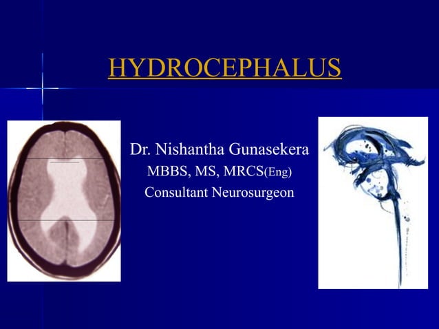 Hydrocephalus.Dr NG NeuroEdu | PPT | Brain and Nervous System Disorders ...