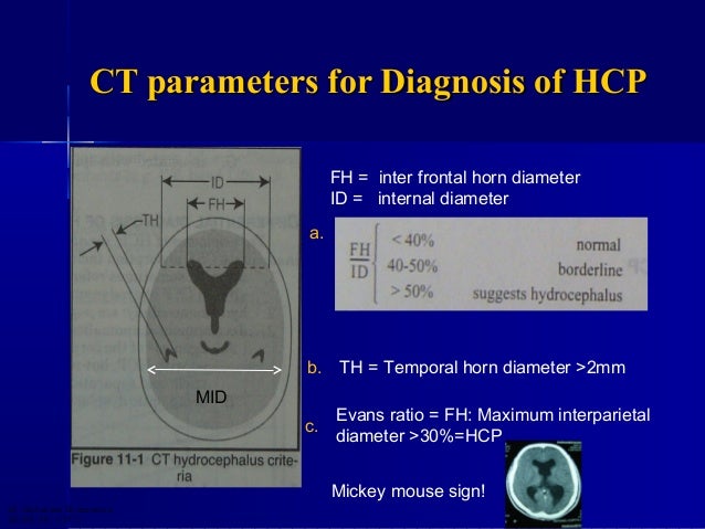 Hydrocephalus.Dr NG NeuroEdu
