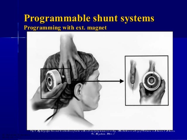 Hydrocephalus.Dr NG NeuroEdu
