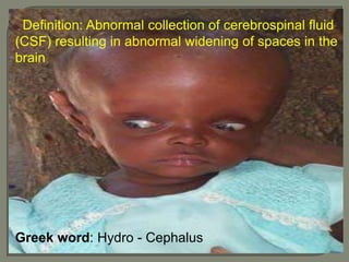 Hydrocephalus | PPTX