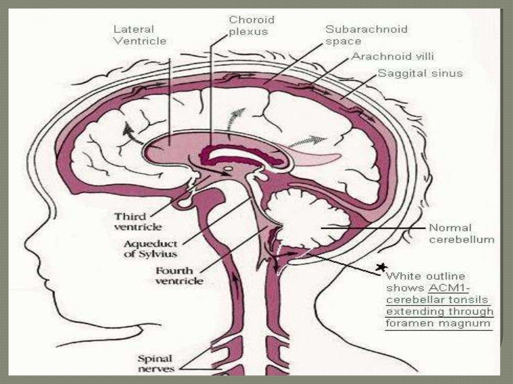 Hydrocephalus arten – PZGI