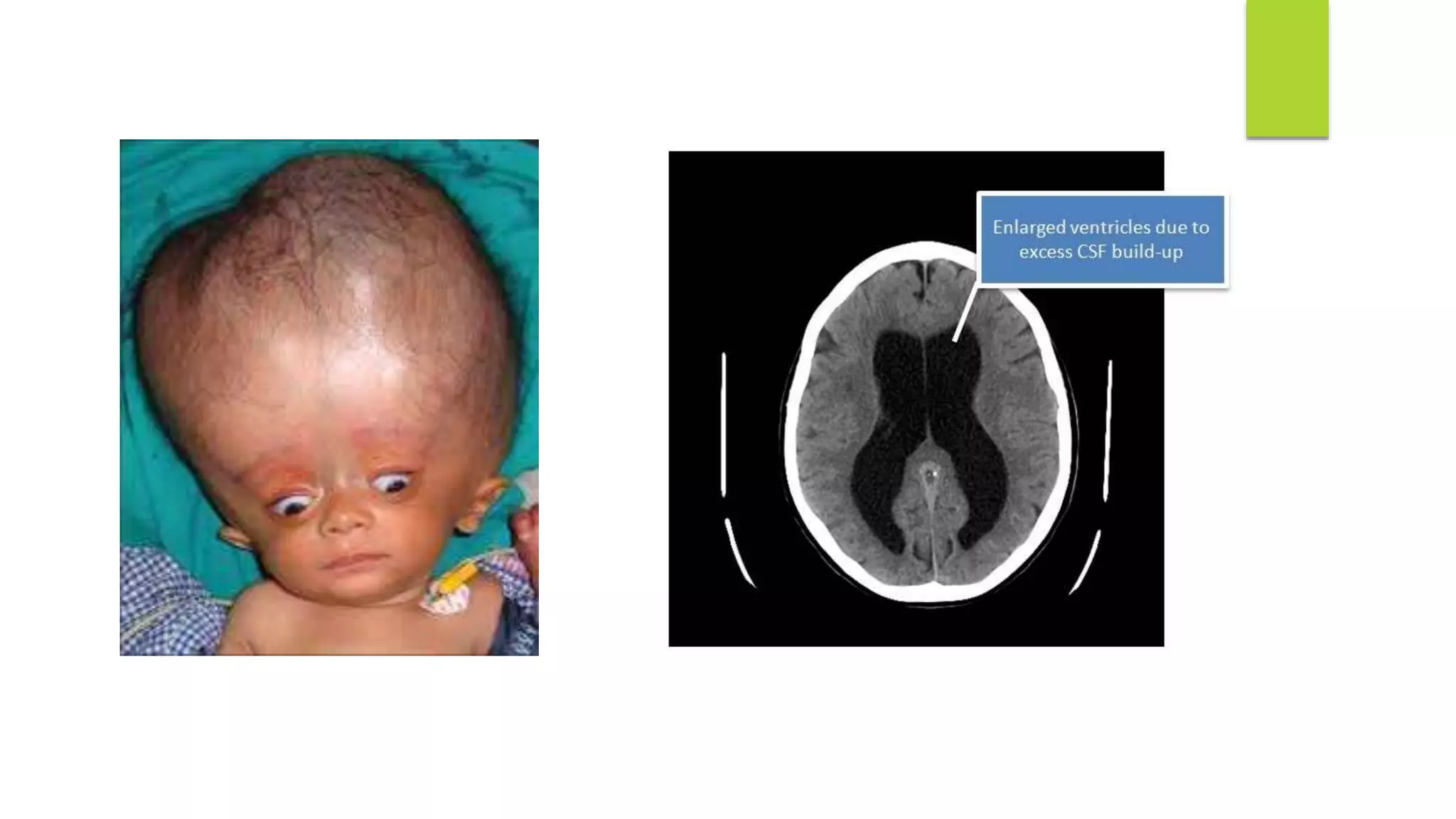 Hydrocephalus , Spina Bifida and craniosynotosis | PPT