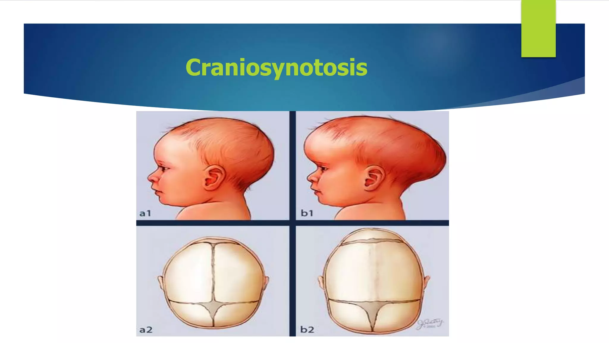 Hydrocephalus , Spina Bifida and craniosynotosis | PPT