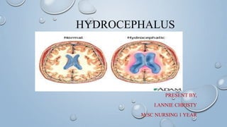 Hydrocephalus for adult | PPTX