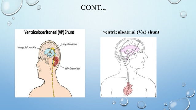 Hydrocephalus for adult | PPTX | Brain and Nervous System Disorders ...