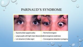 Hydrocephalus for adult | PPTX