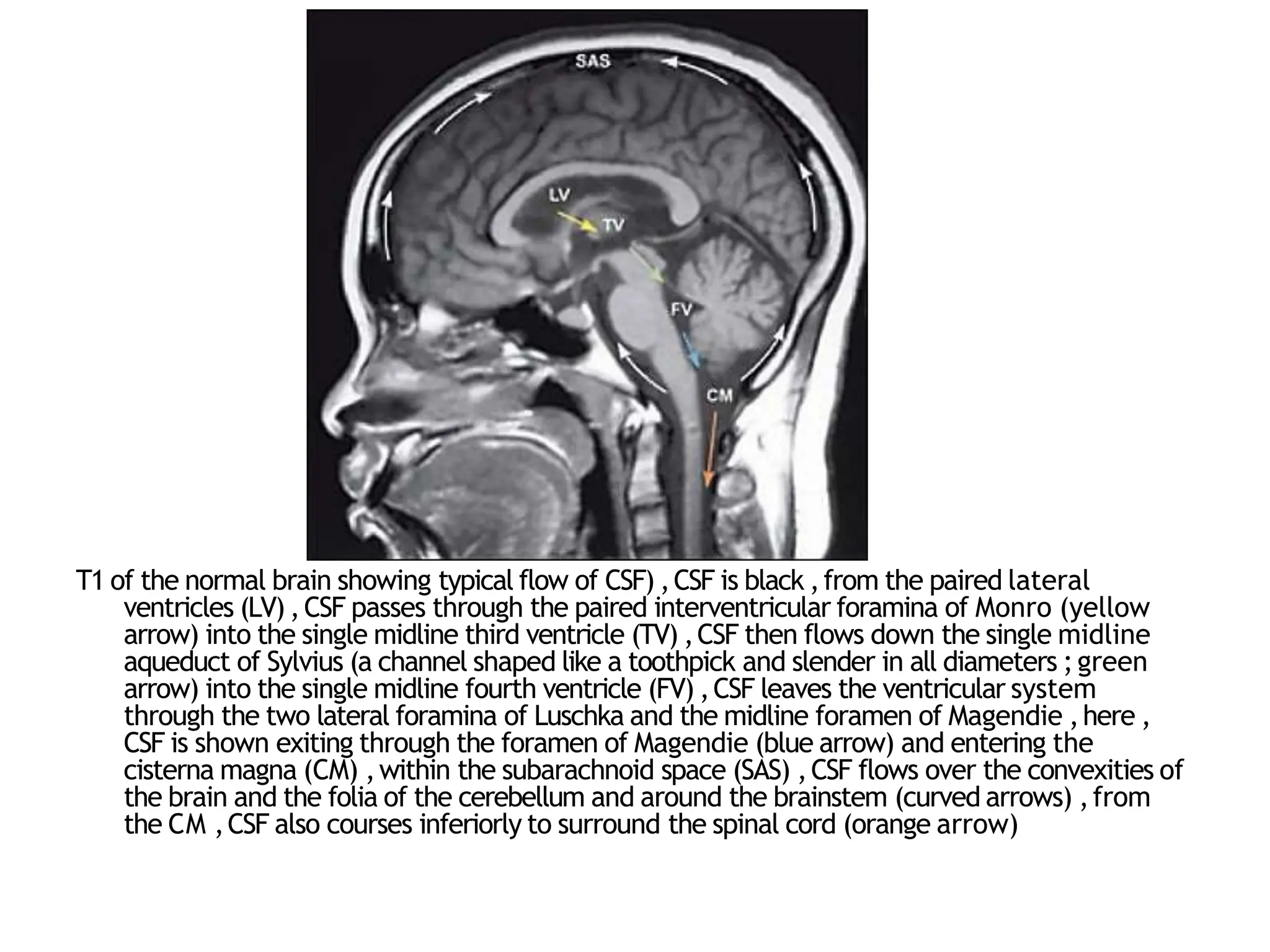 hydrocephalus and csf disorders powerpoint | PPTX
