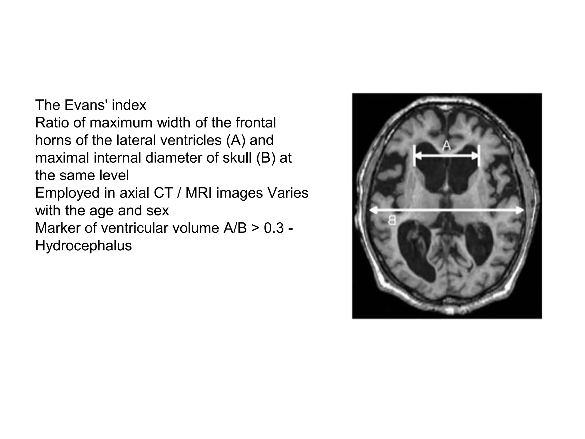 hydrocephalus and csf disorders powerpoint | PPTX
