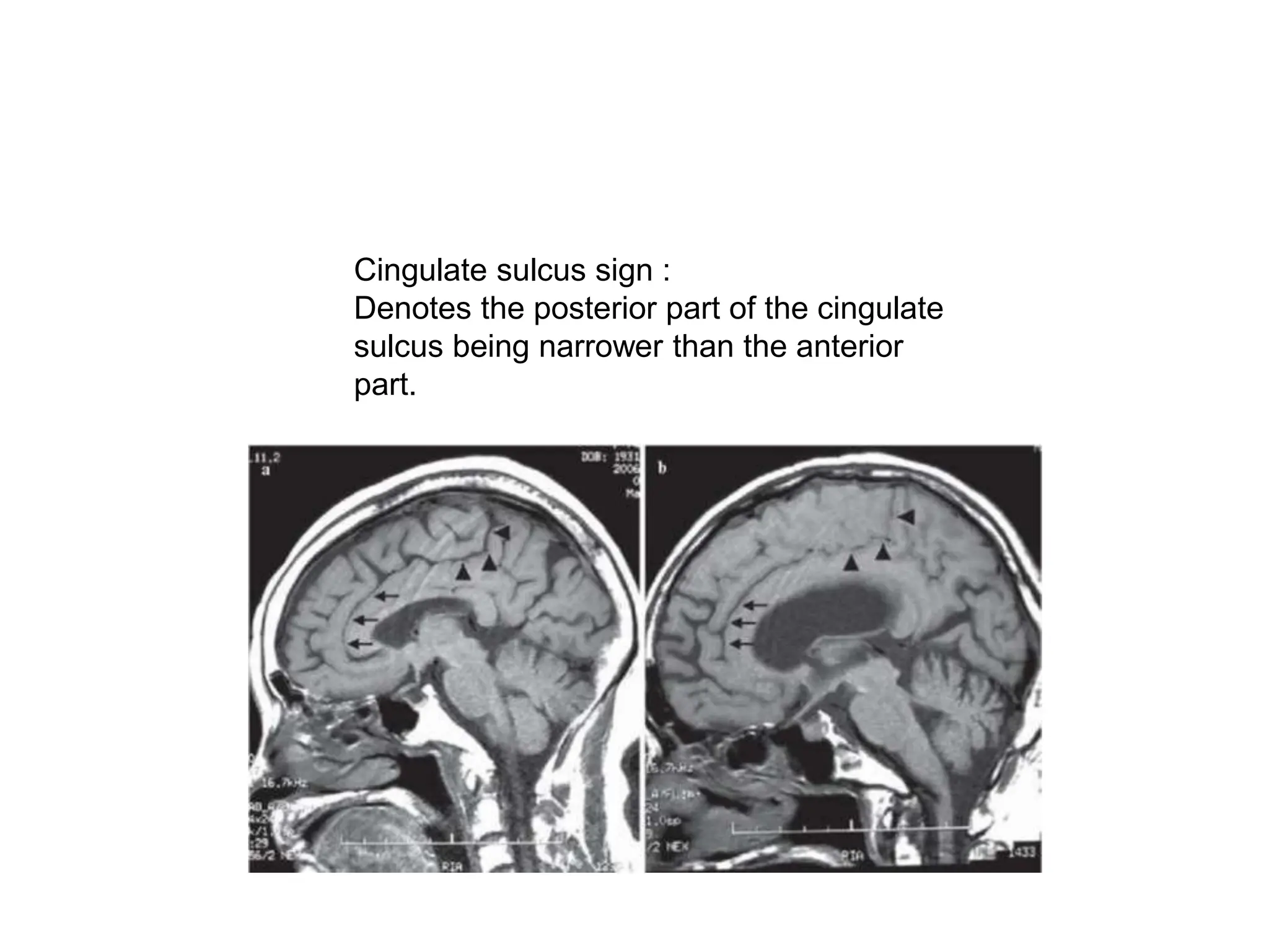 hydrocephalus and csf disorders powerpoint | PPTX