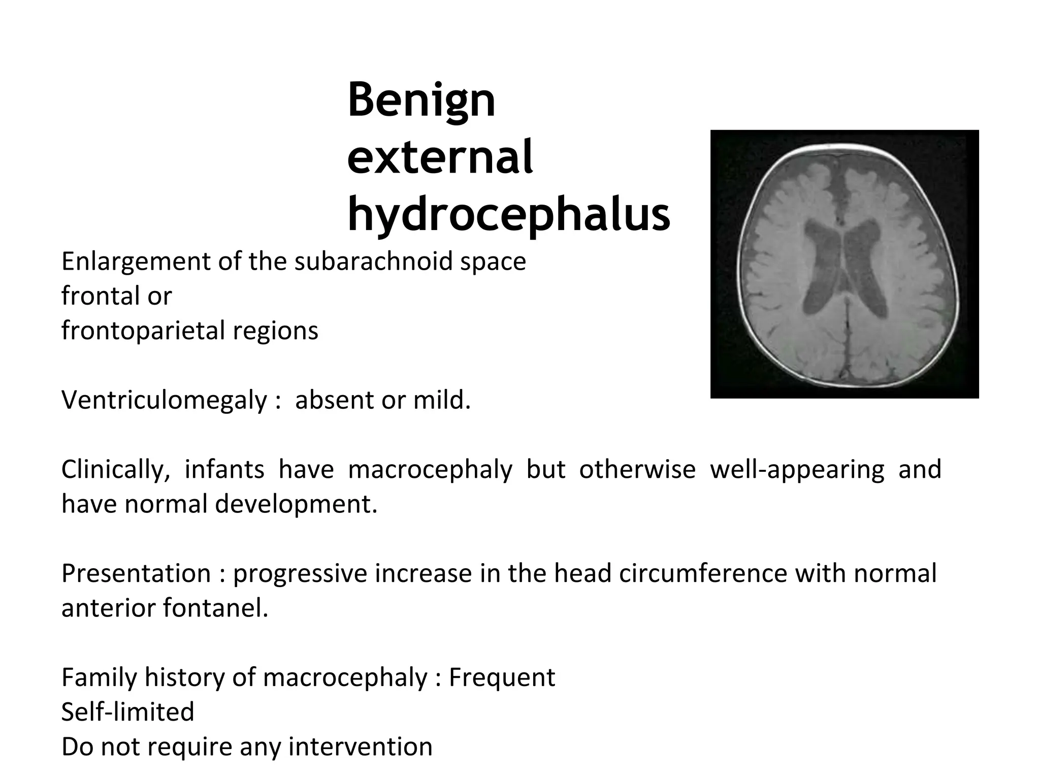 hydrocephalus and csf disorders powerpoint | PPTX