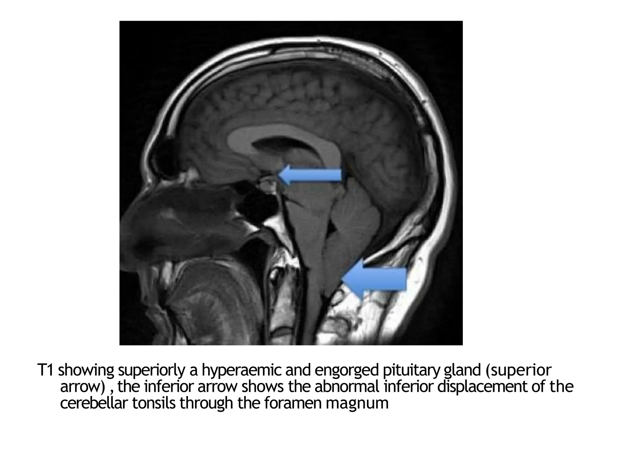 hydrocephalus and csf disorders powerpoint | PPTX