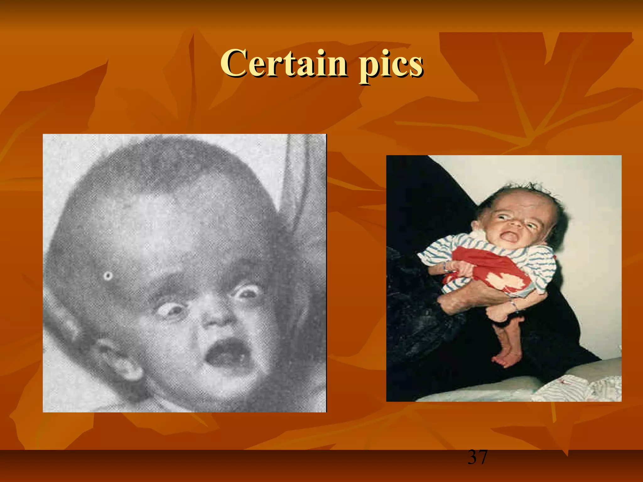 Hydrocephalus project | PPT