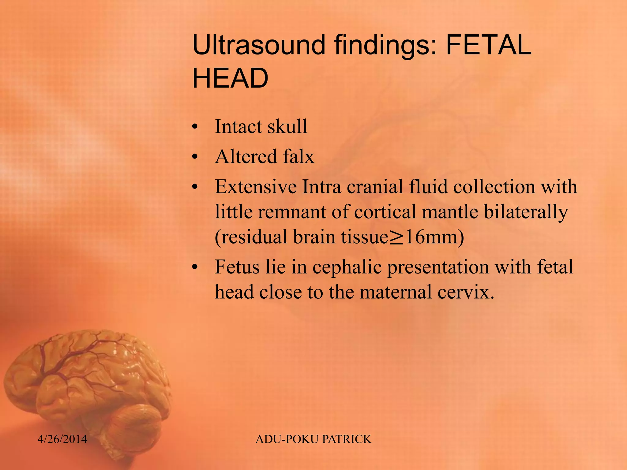 Hydrocephalus with fetal hydrops | PDF