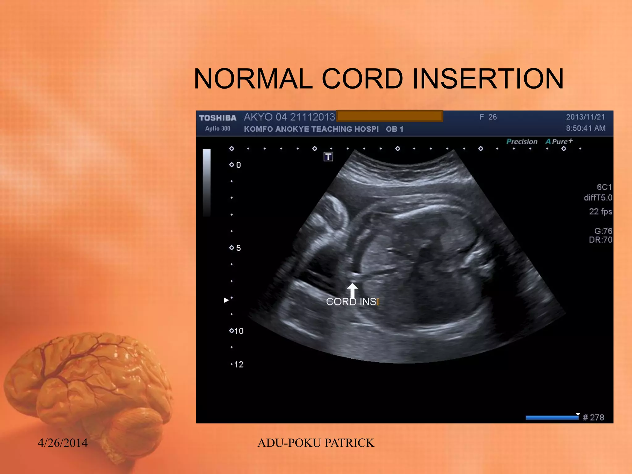 Hydrocephalus with fetal hydrops | PDF