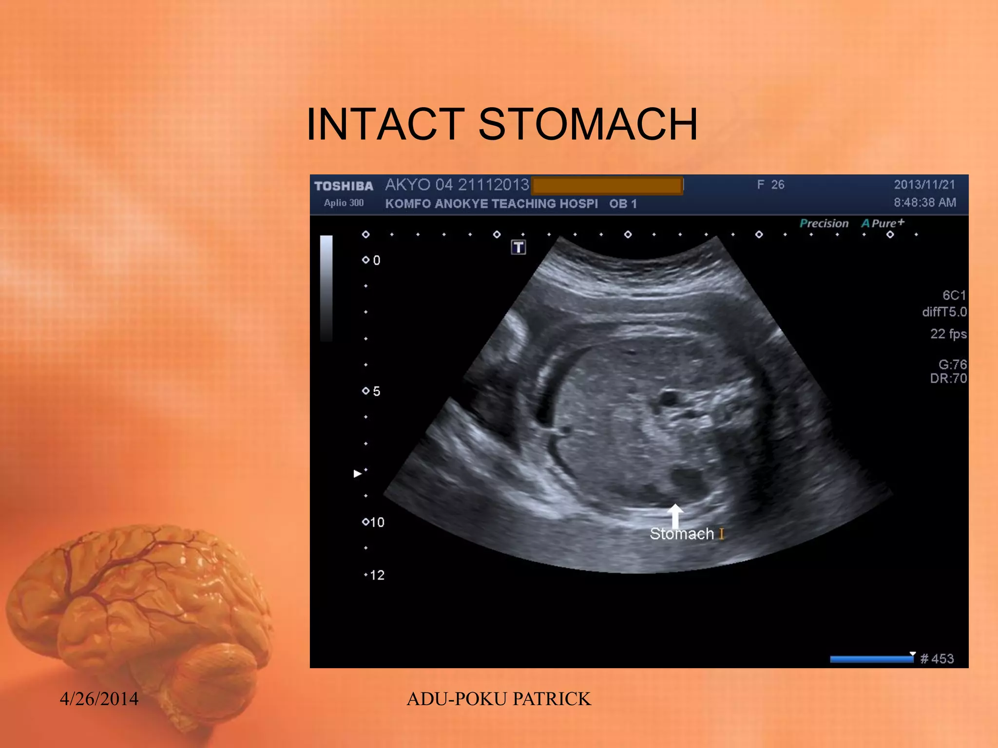 Hydrocephalus with fetal hydrops | PDF