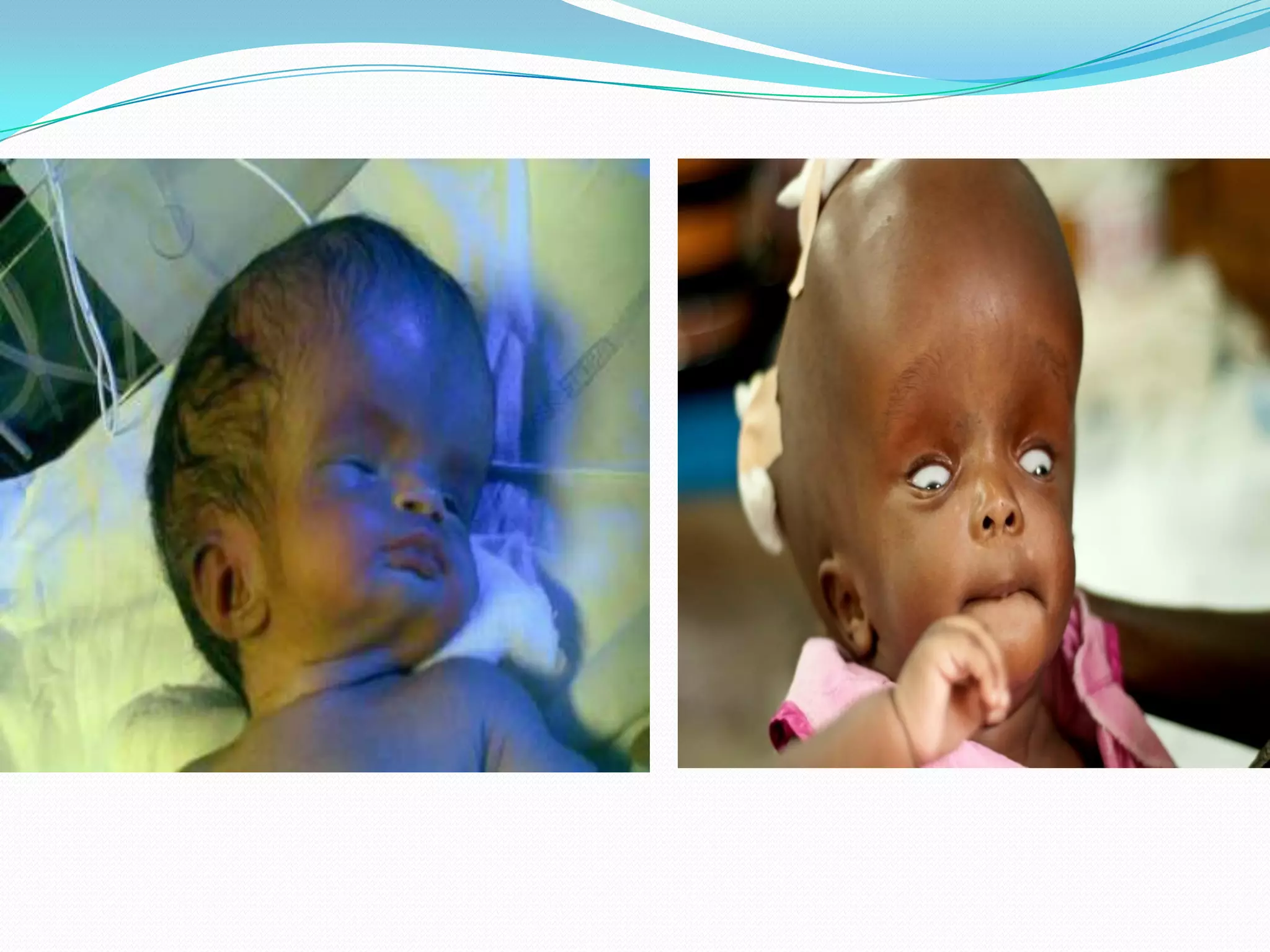 Hydrocephaly | PPT