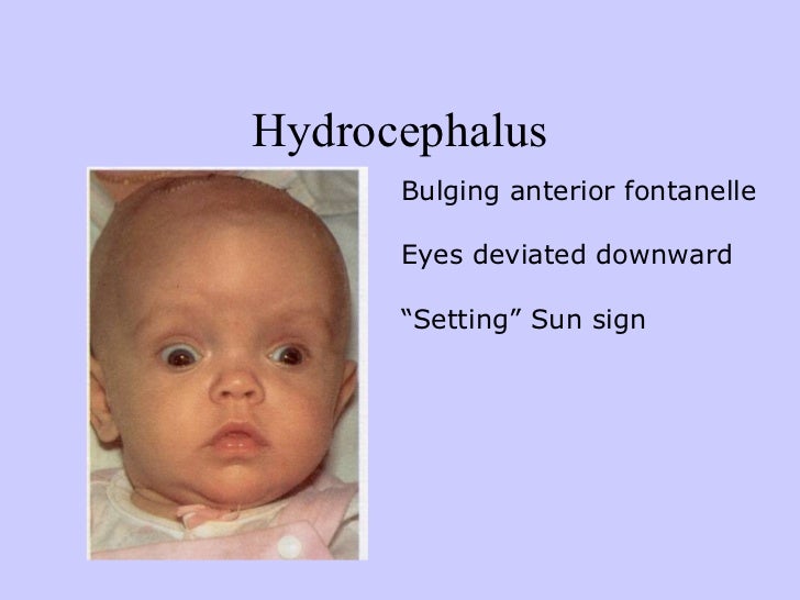 Hydrochephalus