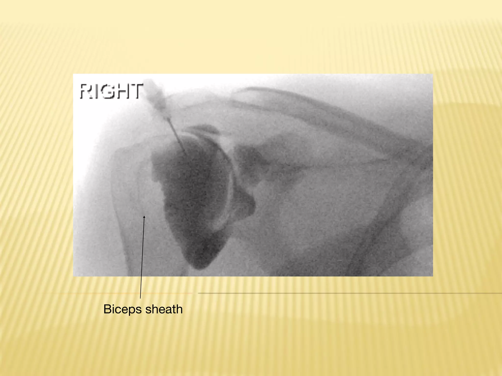 Hydrodilatation distension for frozen shoulder wrightington 2011 | PDF
