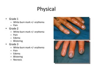 Hydrofluoric Acid Burns