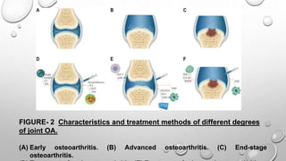 Hydrogels in Osteoarthritis [Autosaved].pptx