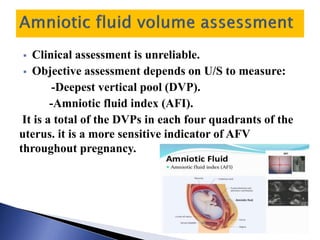 Hydrominos in Pregnancy | PPTX