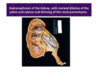 Hydronephrosis 130818162124-phpapp01 | PPT