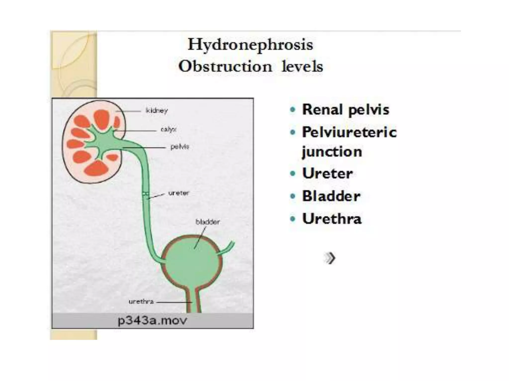 Hydronephrosis | PPTX