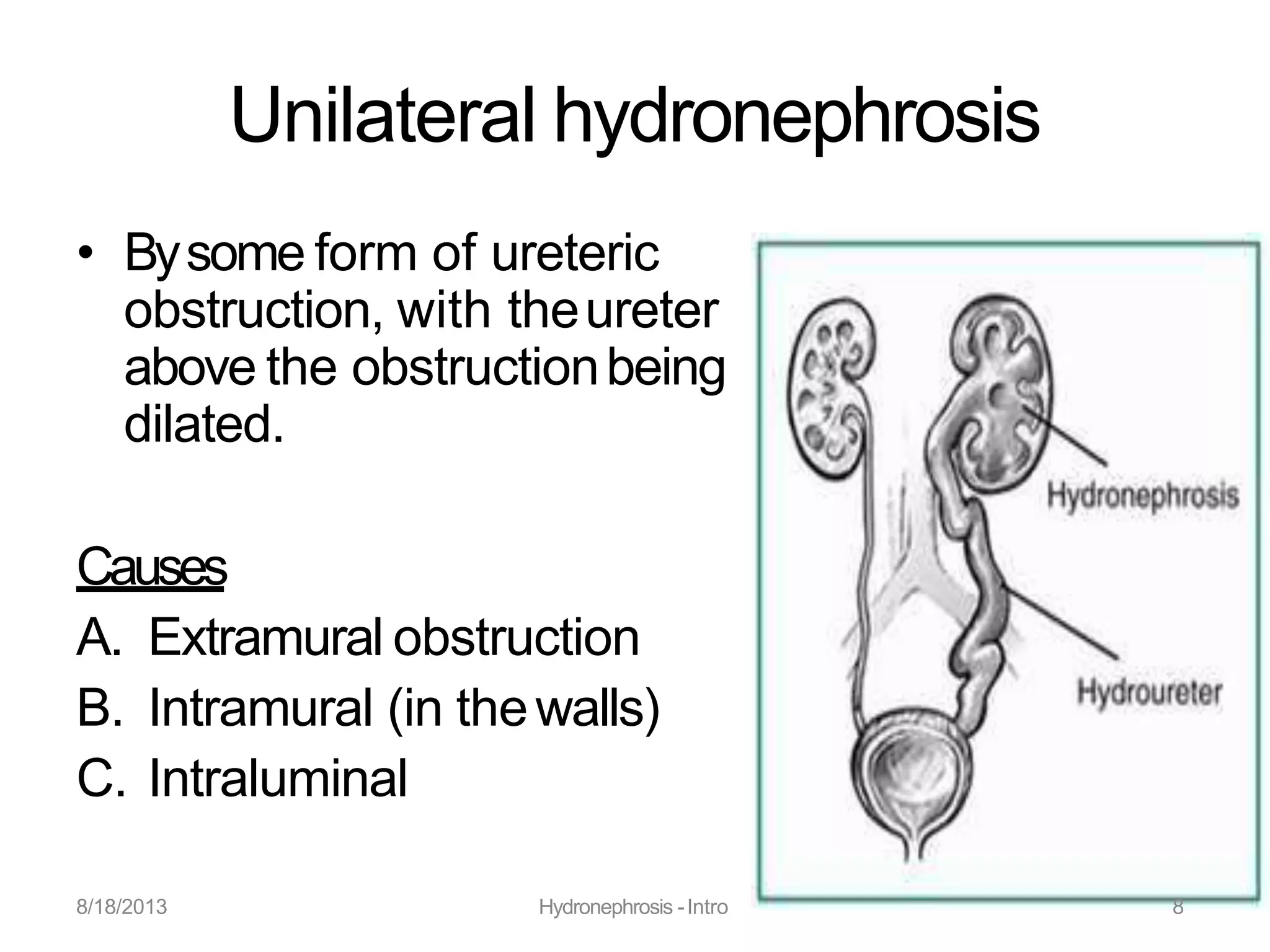 Hydronephrosis | PPTX