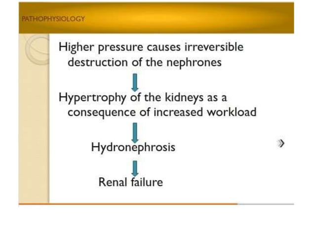 Hydronephrosis | PPTX